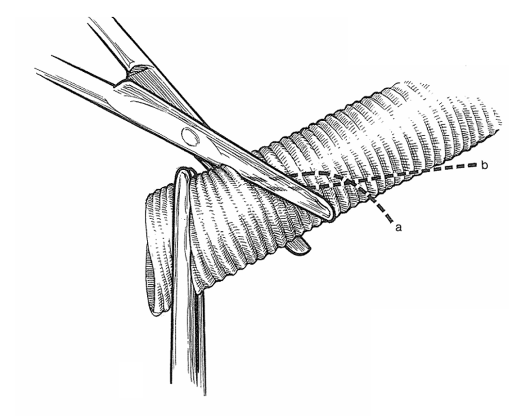 Tips and Tricks for Vascular Anastomoses - Andreas M Lazaris, MD