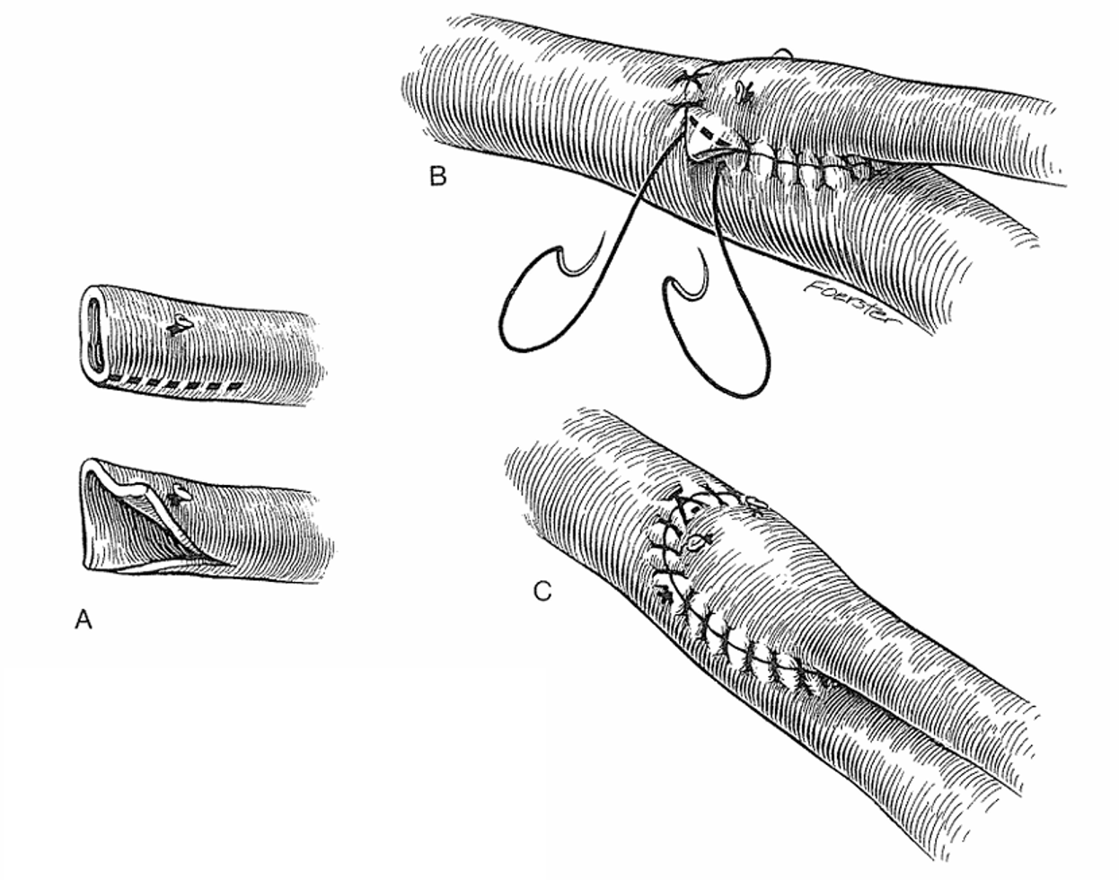 Tips and Tricks for Vascular Anastomoses - Andreas M Lazaris, MD
